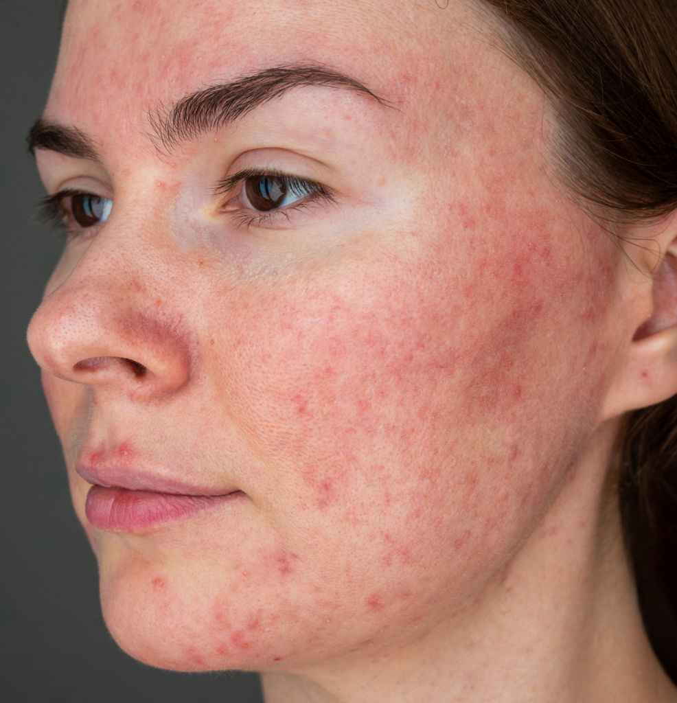 Rosacea - Causes & Treatments | San Antonio Dermatologist