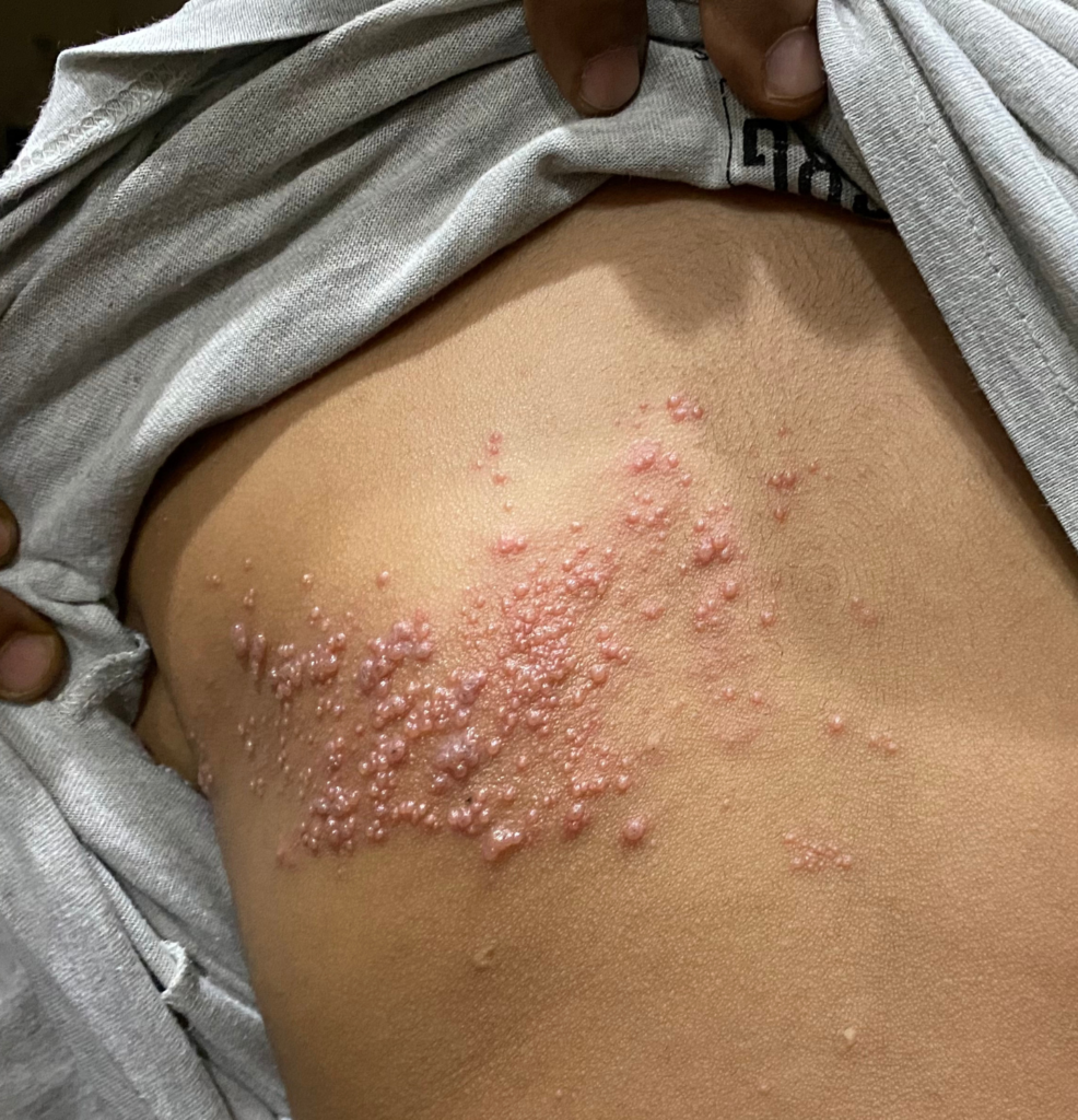 Shingles Causes & Treatment | San Antonio | LIV Dermatology