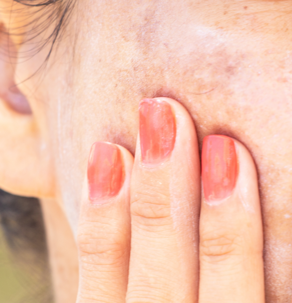 Sun Spots - Causes & Treatments | San Antonio Clinic