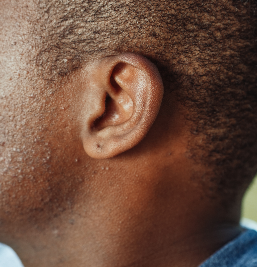 Repair Damaged Earlobes Treatment | San Antonio Dermatology
